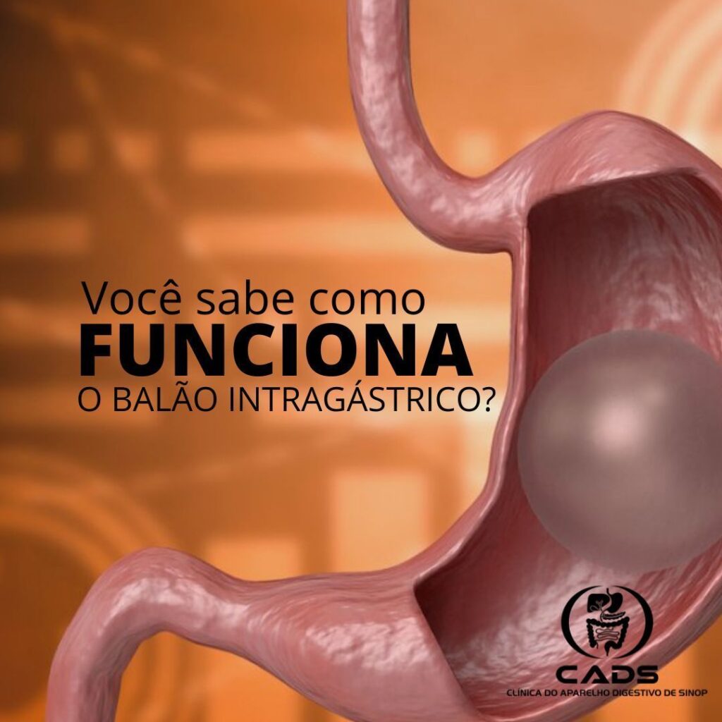 Você sabe como funciona o balão intragástrico? – CADSINOP